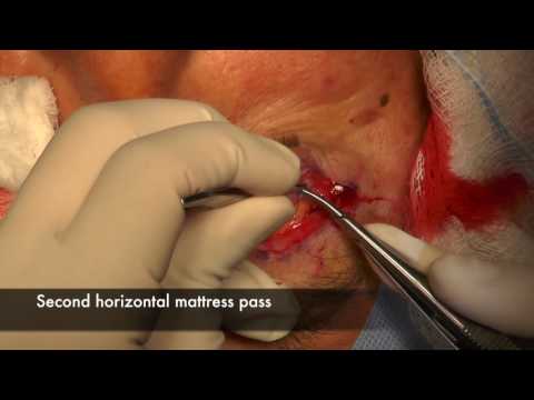 External Ptosis Repair