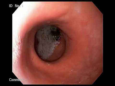 Normal oesophago-gastro-duodenoscopy.