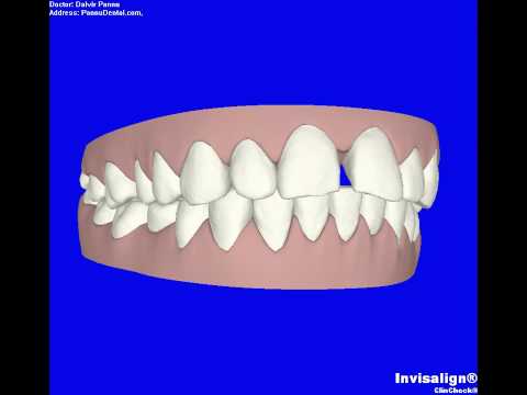 Spacing(Diastema) treated with Invisalign CH of Fremont – Dalvir Pannu DDS