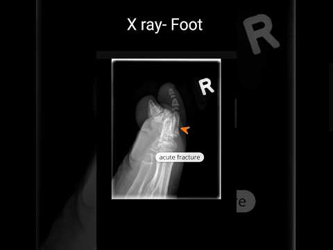 x -ray Foot -Proximal phalanx fracture - 2nd toe. #viralshorts
