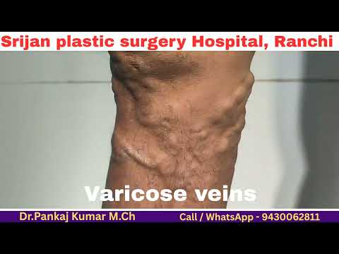 Varicose veins treatment in Ranchi | Laser & foam Sclerotherapy treatment of varicose veins