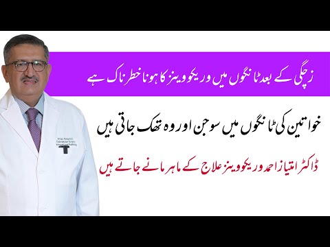 PREGNANCY & VARICOSE VEINS: What to know & how to prevent them | Dr Imtiaz Ahmad