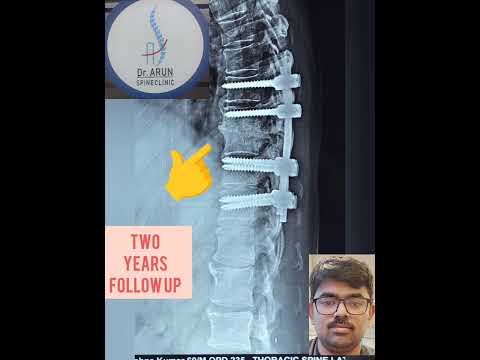 spondylodiscitis with prevertebral abscess