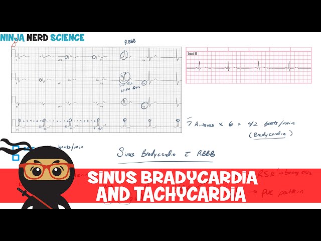 Understanding Sinus Bradycardia and Sinus Tachycardia: Rate and Rhythm ...
