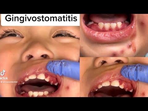 Herpetic Gingivostomatitis in Kids