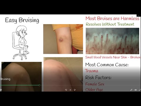 Easy bruising - Why It Happens, When To Be Concerned