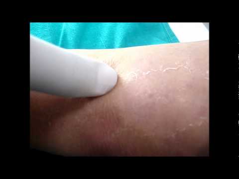 FACTORS influencing Cellulitis & How To Manage CELLULITIS LEG ?