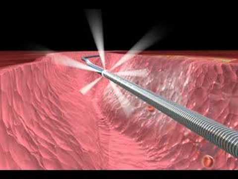 3d Medical device stent deployment heart blood cell 3d medical animation stent deployment Tres3d