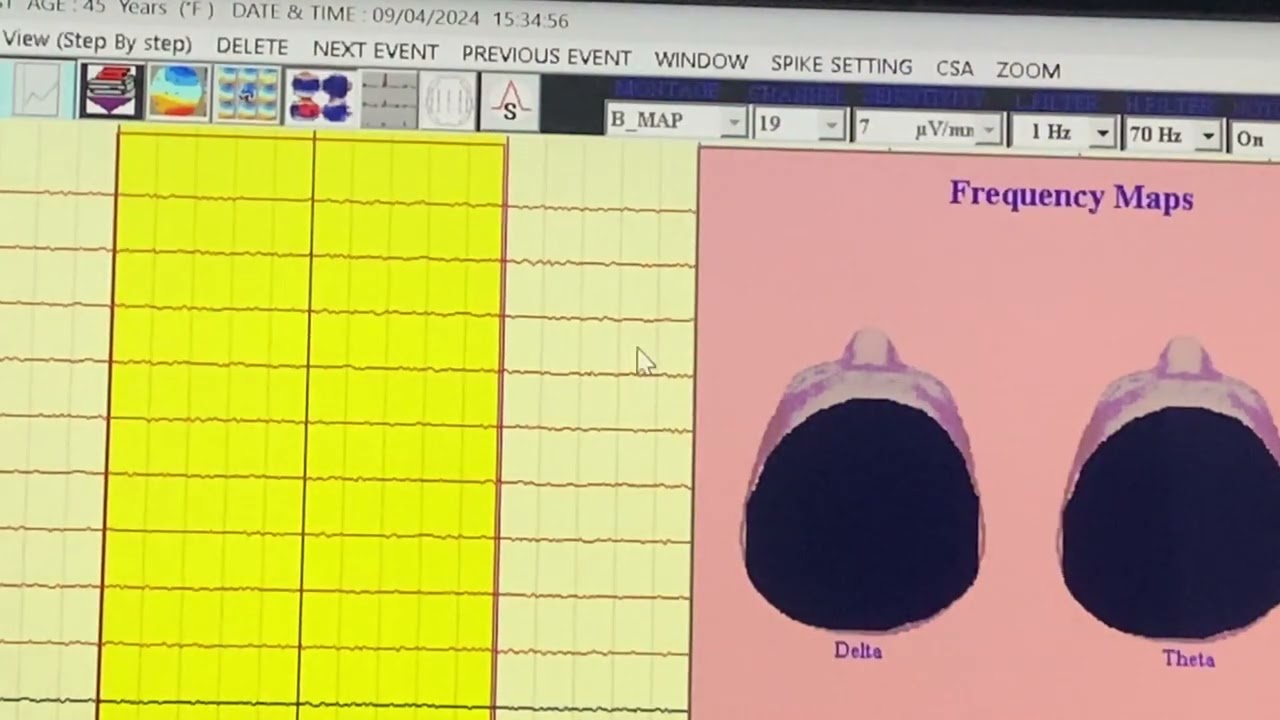 How to Make MEDICAID EEG GRAPH PDF