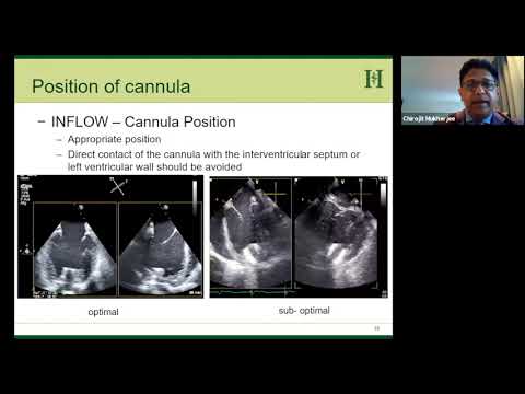 TEE in heart failure for LVAD by Dr Chirojit Mukherjee Germany