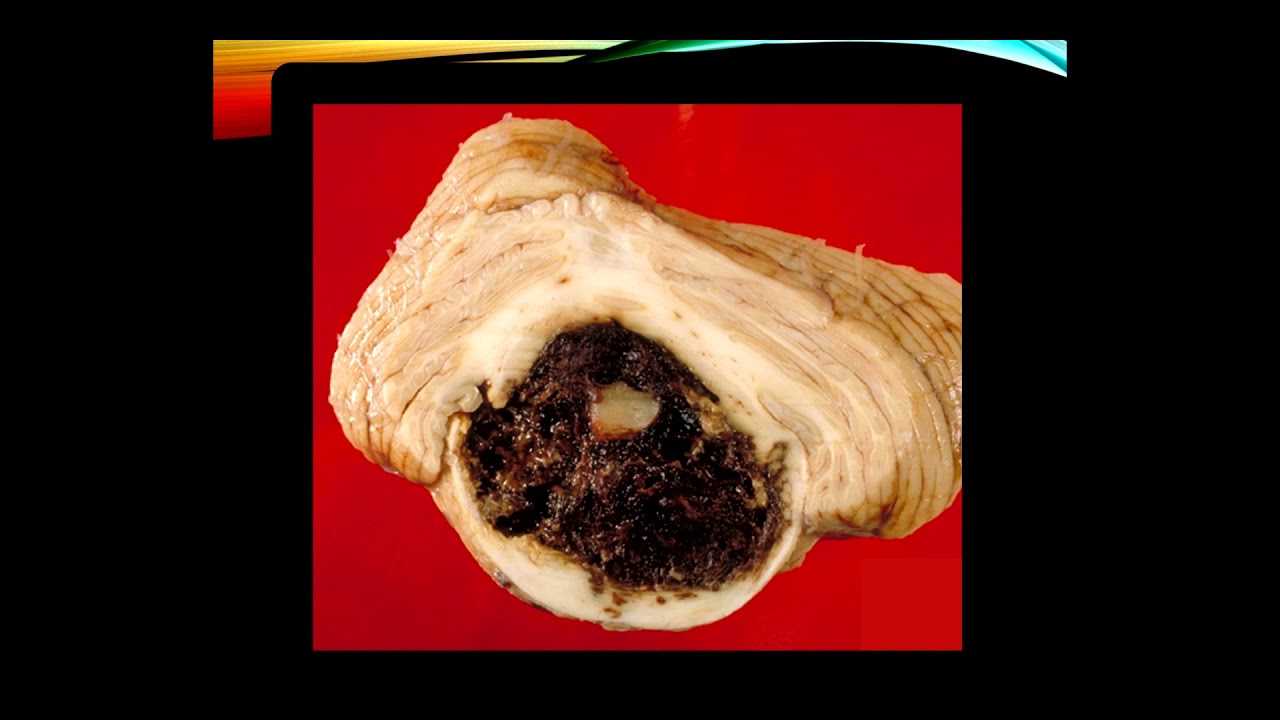 Cerebrovascular Disease, Part 2