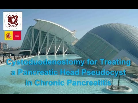 Cystoduodenostomy for Treating a Pancreatic Head in Chronic Pancreatitis
