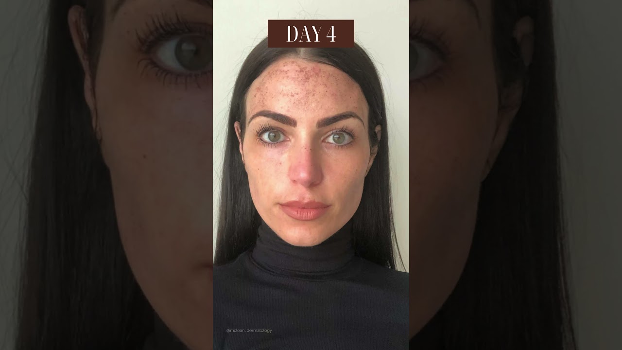 What to expect after IPL treatment! #IPL #cosmeticlaser #lasertreatment