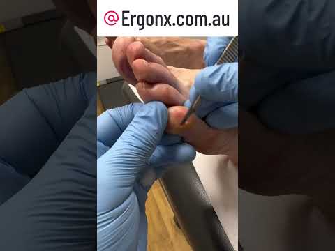 Little toe callus (hard skin) removal by podiatrist this makes the pinky toe more comfortable