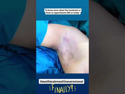 Axillary Breast tissue remedies | Armpit fat tissue removal only at Dr.Karishma Aesthetics #selfcare