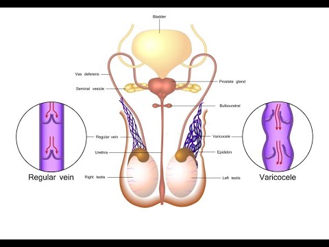 Varicocele Pain - Let's Talk!