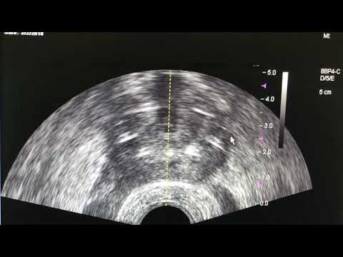 AUA Urology Teaching Video: Prostate Cryoablation: Techniques for Safe and Effective Therapy