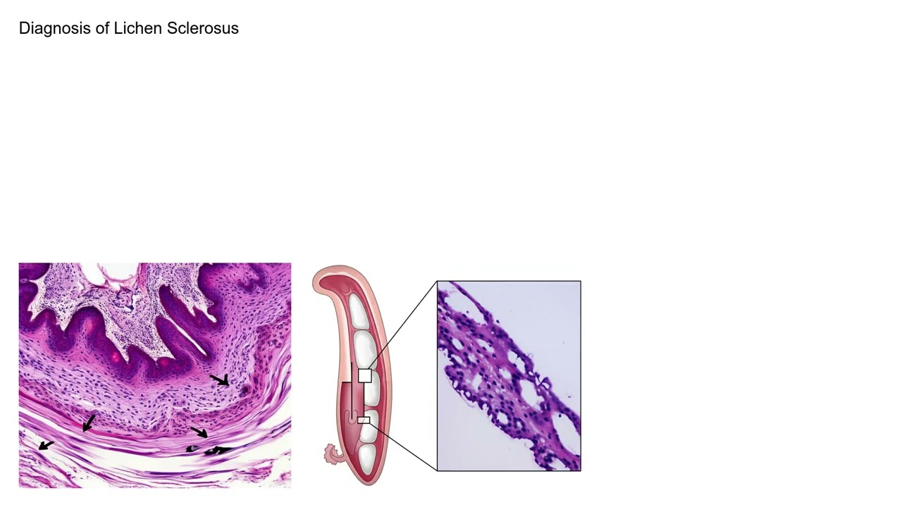 Penile lichen sclerosus Explained Causes, Symptoms and Treatment, All Insights