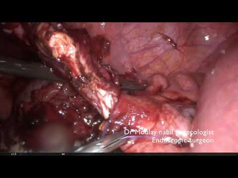 Diffuse Peritonitis Following acute appendicitis