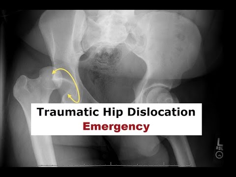 Traumatic Hip Dislocation Emergency