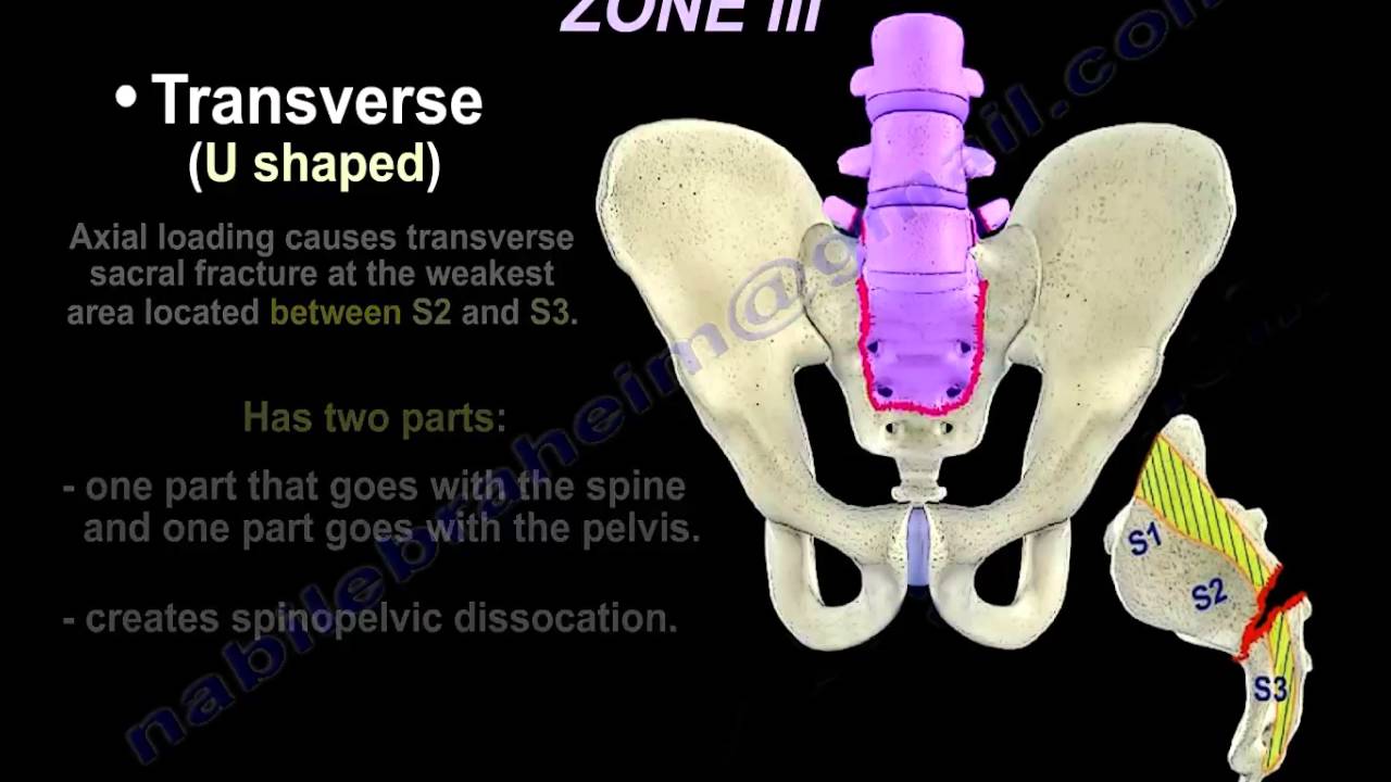 Sacral Fractures , Review - Everything You Need To Know - Dr. Nabil Ebraheim