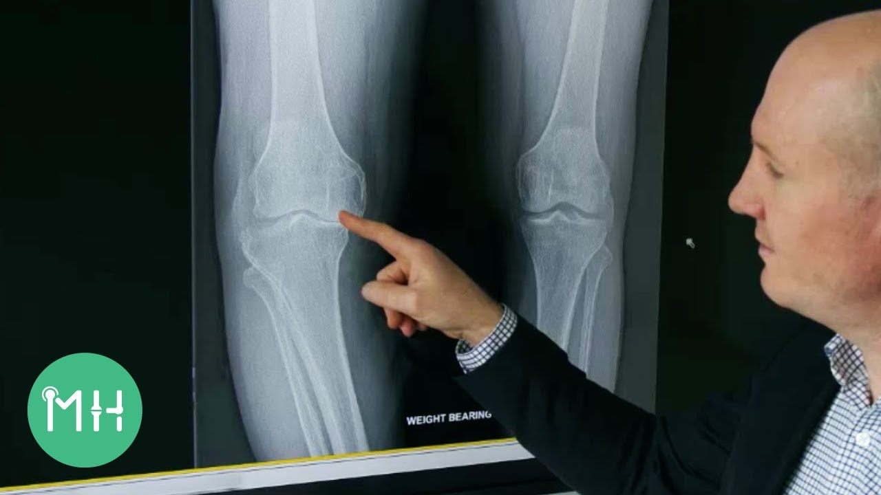 How does arthritis affect the knee joint?