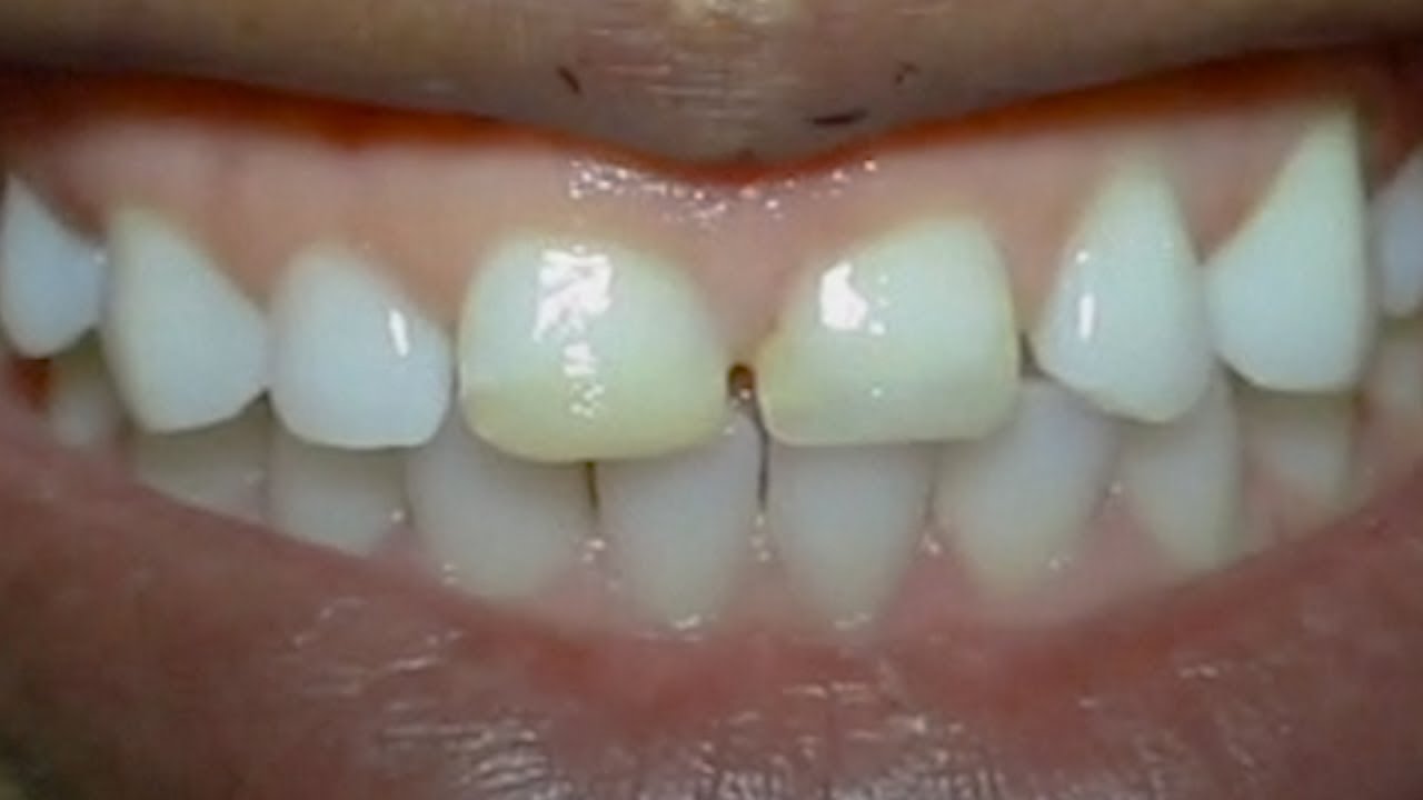 2017 How to FIX Gap Teeth! Online, Cheap, Fast and No Braces and NO DENTIST! Brighter Image Lab