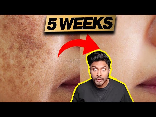 The Ultimate Guide to Treating Hyperpigmentation: Skincare Routines ...