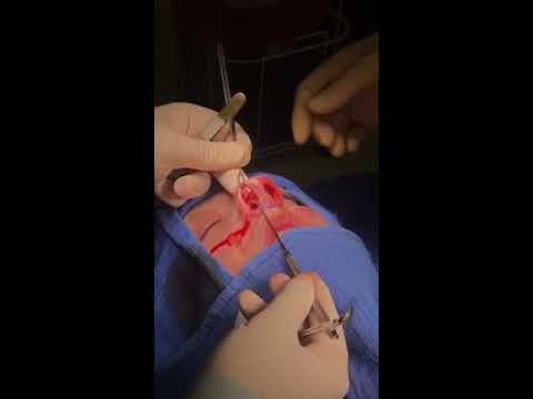Hochstein Rhiinoplasty Video
