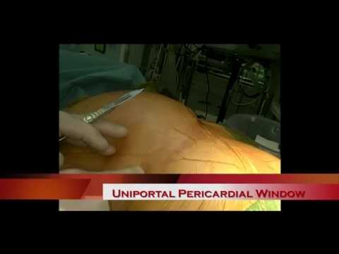 Pericardial Window Procedure Steps