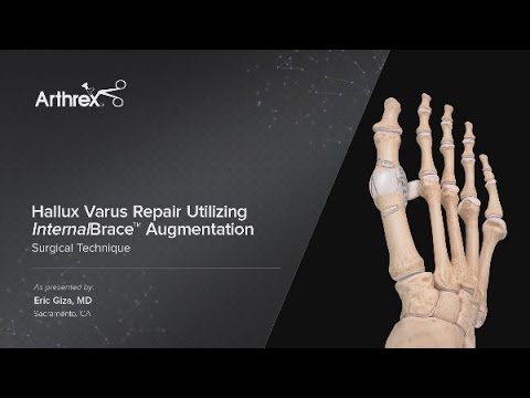 Hallux Varus Repair Utilizing InternalBrace™ Augmentation