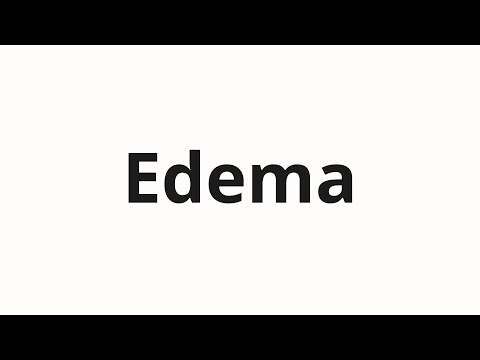 How to pronounce Edema