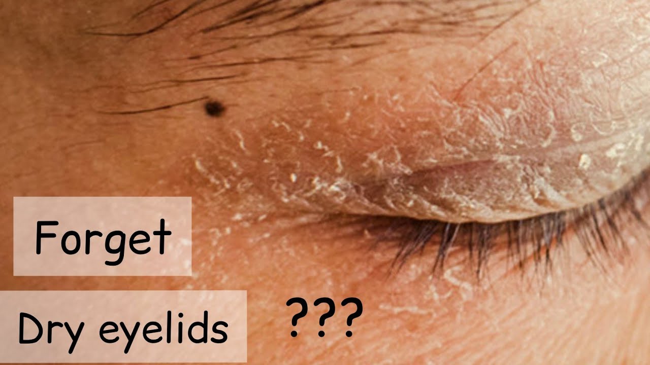 Dryness on Eyelids and Face Simple Home Remedy  ?? Dry Skin around Eyelids Treatment ??
