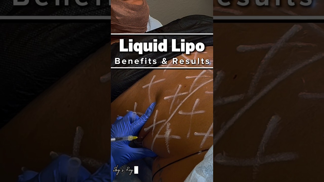 Body contouring, no surgery required! Las Vegas, NV ✅Liquid Lipo #bestoflasvegas #cosmeticsurgery