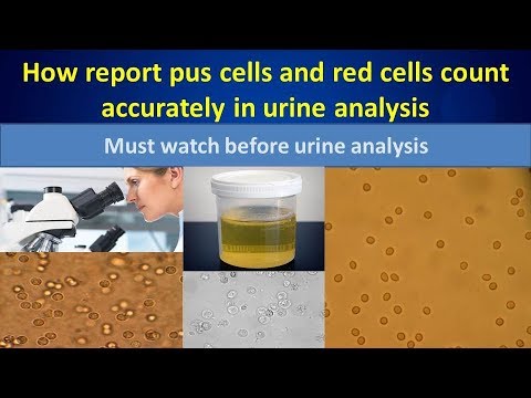 How report pus cells, red cells in urine deposit.#Urineanalysis#Urine#UFR#Urinefullreport.