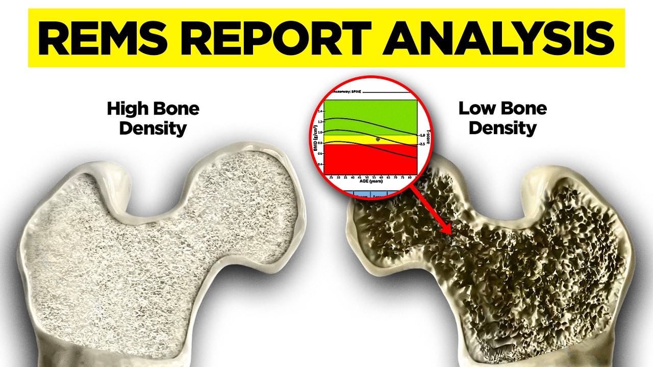 Understanding My Bone Transformation: A Deep Dive into REMS Reports ...