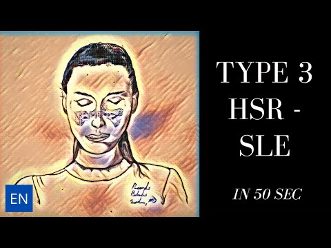 Hypersensitivity in SLE #Shorts
