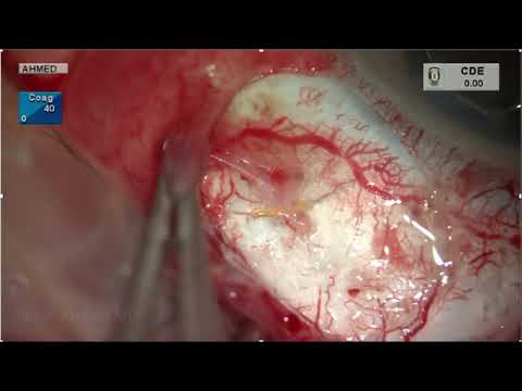Recommendations for the management of elevated IOP-Sub ID 195457