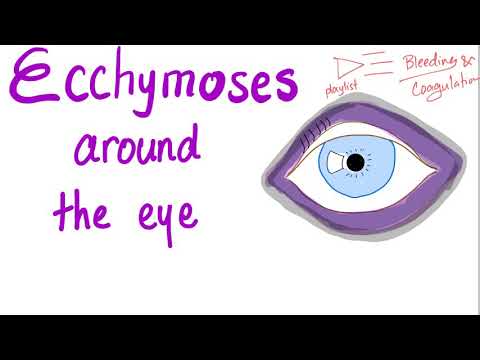 Ecchymoses around the eye