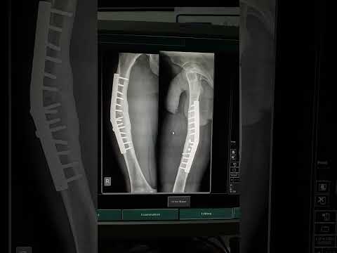 #femur fracture 27Y Male Pt #radiology