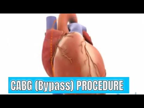 CABG (Coronary artery bypass graft) surgery explained