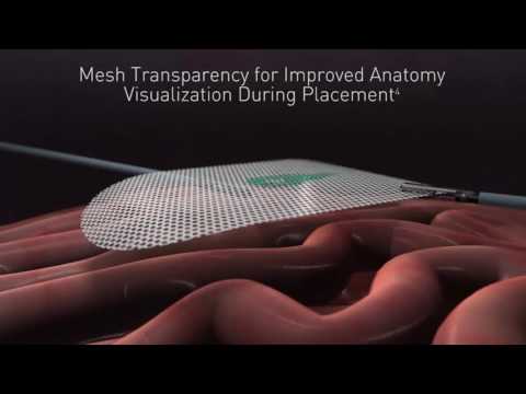 Hernia Mesh - Hernia Kit Latest Price, Manufacturers & Suppliers