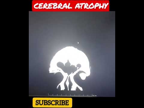 Cerebral Atrophy - CT & MRI features - Radiology