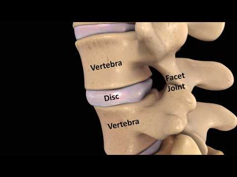 An Alternative to Spinal Fusion Surgery - The Regenexx Perc-FSU Procedure