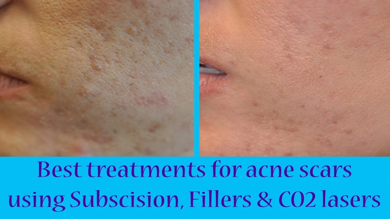 Best Treatments for Acne Scars Using Subscision, Fillers & CO2 Laser | Dr. Rinky Kapoor