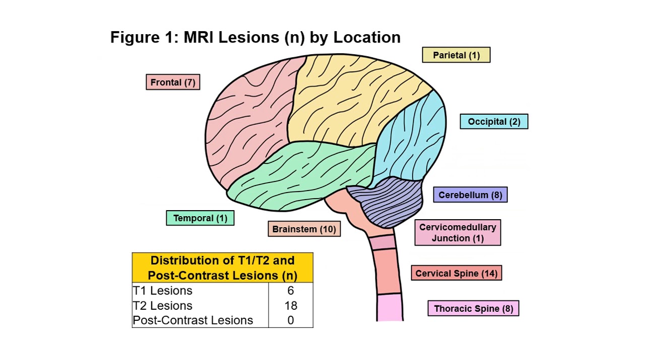 #40 ASSOCIATIONS BETWEEN MRI AND URODYNAMIC FINDINGS AMONG MULTIPLE SCLEROSIS PATIENTS WITH URIN...