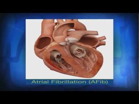 Atrial Fibrillation May Lead to Serious Health Issues