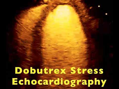 Stress Echo Dobutrex: Apical Dyskinesia & Severe Coronary Lesions (LDA & LCX)
