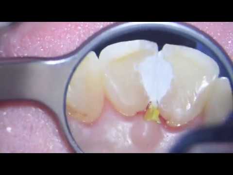 Dental Filling Material - Dental Fillings Latest Price, Manufacturers ...