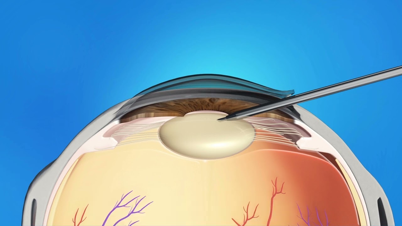 How is a Standard Cataract Surgery done? | Step-by-Step Guide 🏥